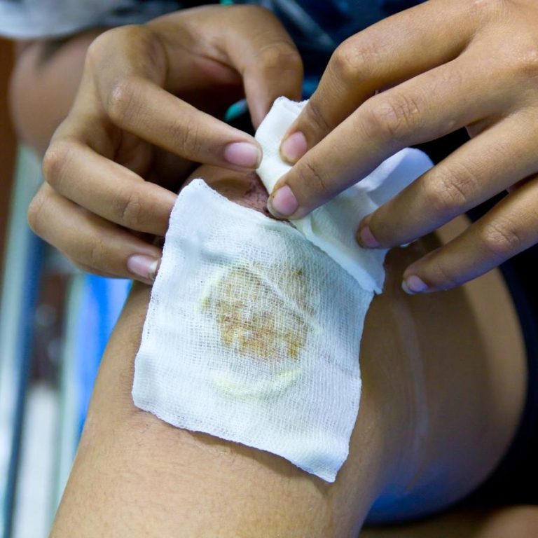 Curativo ferida operatória: tratar e prevenir infecções - MEM Cirúrgica
